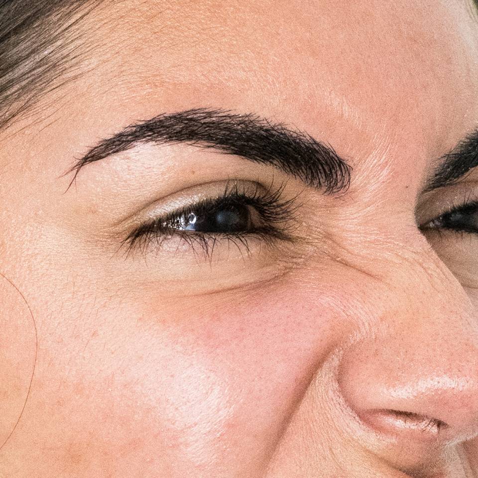 Botox® Treatment | Ideal Image